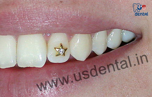 Get Sparkling Pearly Smiles with Teeth Jewellery this Diwali - Usdental