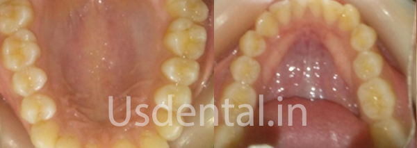 Before and After Misalignment Teeth Alignment – Case of the Month ...
