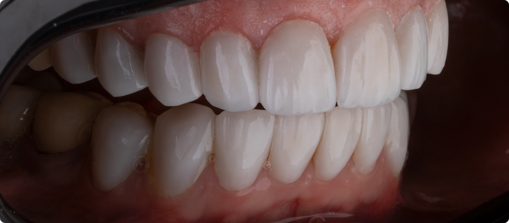 Case of the Month – Upper Front Tooth Crown - Usdental