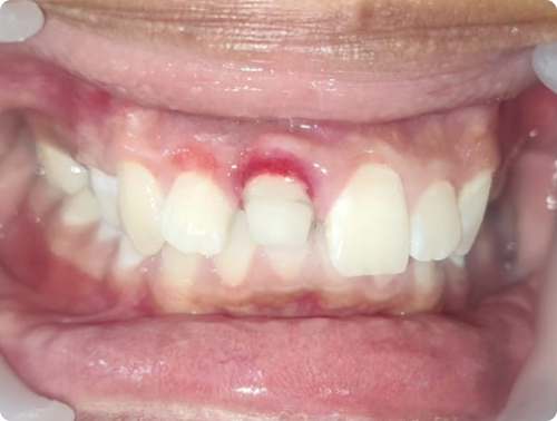 Case of the Month – Upper Front Tooth Crown - Usdental