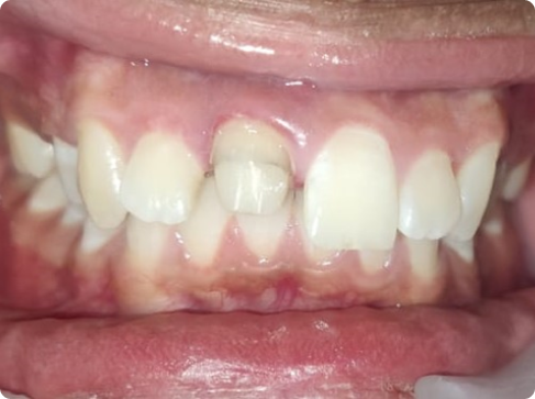 Case of the Month – Upper Front Tooth Crown - Usdental